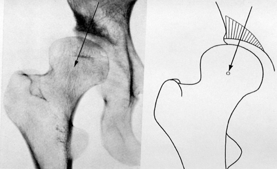 Coxa valga | Dr. med. Markus C. Michel